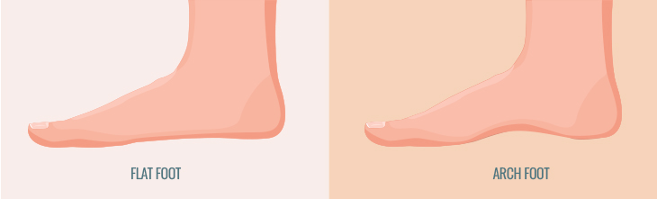 Understanding Flat Feet and Debunking Myths Around It - Fitpage